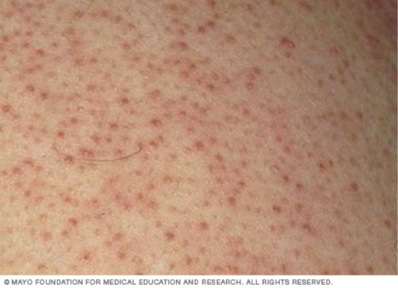Queratosis Pilar – Dermaclínica Queratosis Pilar – Dermaclínica