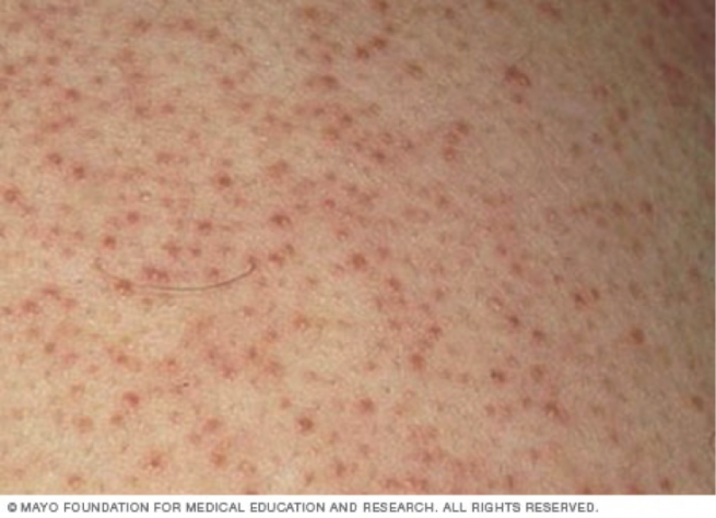 Queratosis Pilar – Dermaclínica